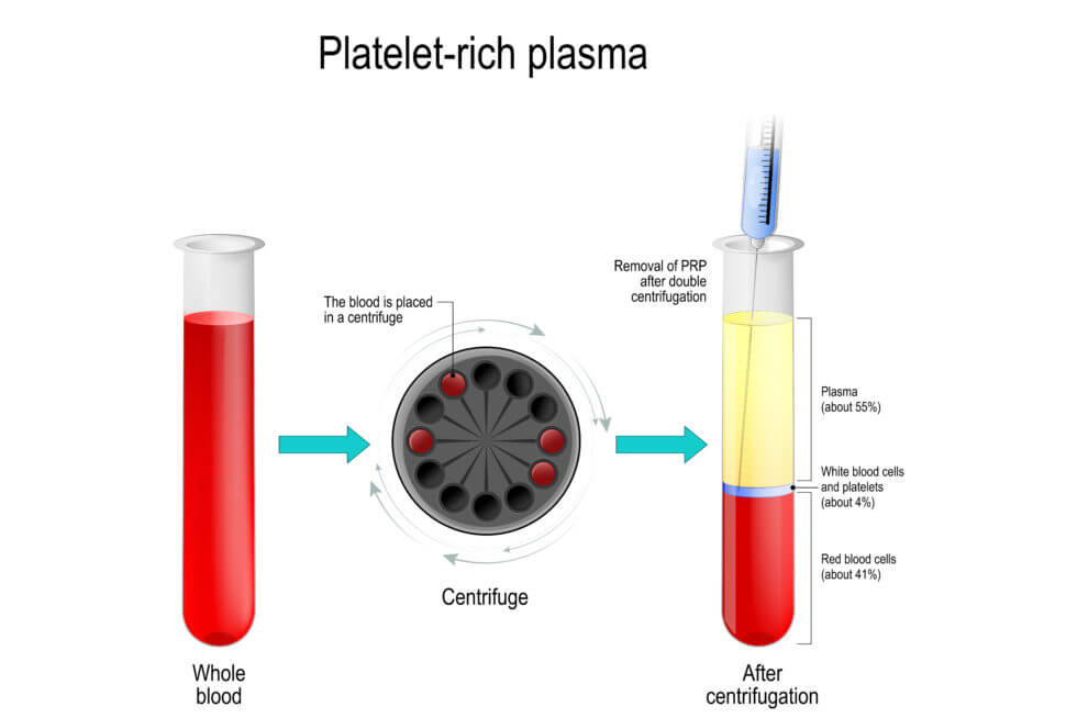 PRP Injections Lexington KY | Plasma Rich Platelet | Anti-Aging Institute